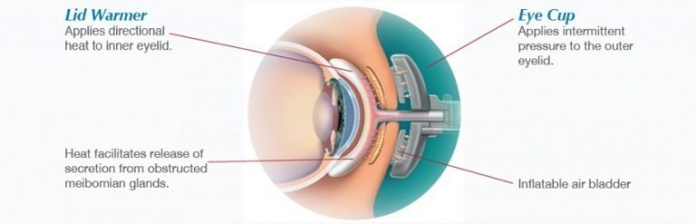 LipiFlow | Wichita Vision Institute | Dry Eye Treatment Wichita
